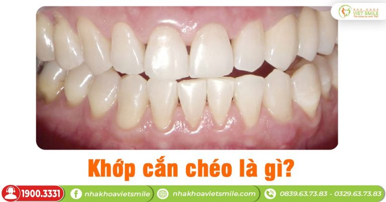 Khớp cắn chéo là gì? Niềng răng khớp cắn chéo có hiệu quả?
