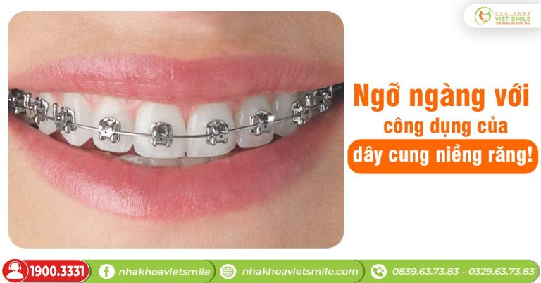 Dây cung niềng răng là gì? Các loại dây cung và công dụng