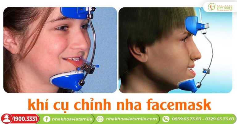 Facemask chỉnh nha là gì? 5 lưu ý khi sử dụng