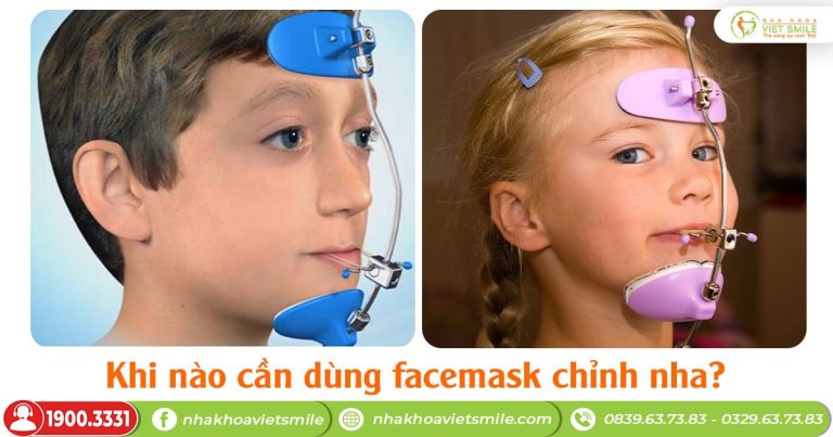 Facemask chỉnh nha là gì? 5 lưu ý khi sử dụng