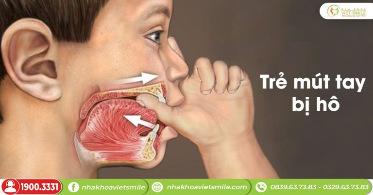 Trẻ mút tay có bị hô không?