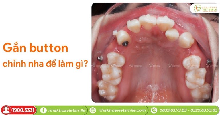 Gắn button chỉnh nha để làm gì?